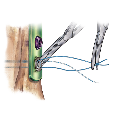 ZipTight™ Ankle Fixation System