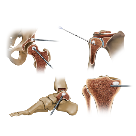Restorative Therapies | Zimmer Biomet
