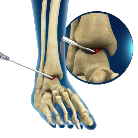 Avitus® DragonWing™