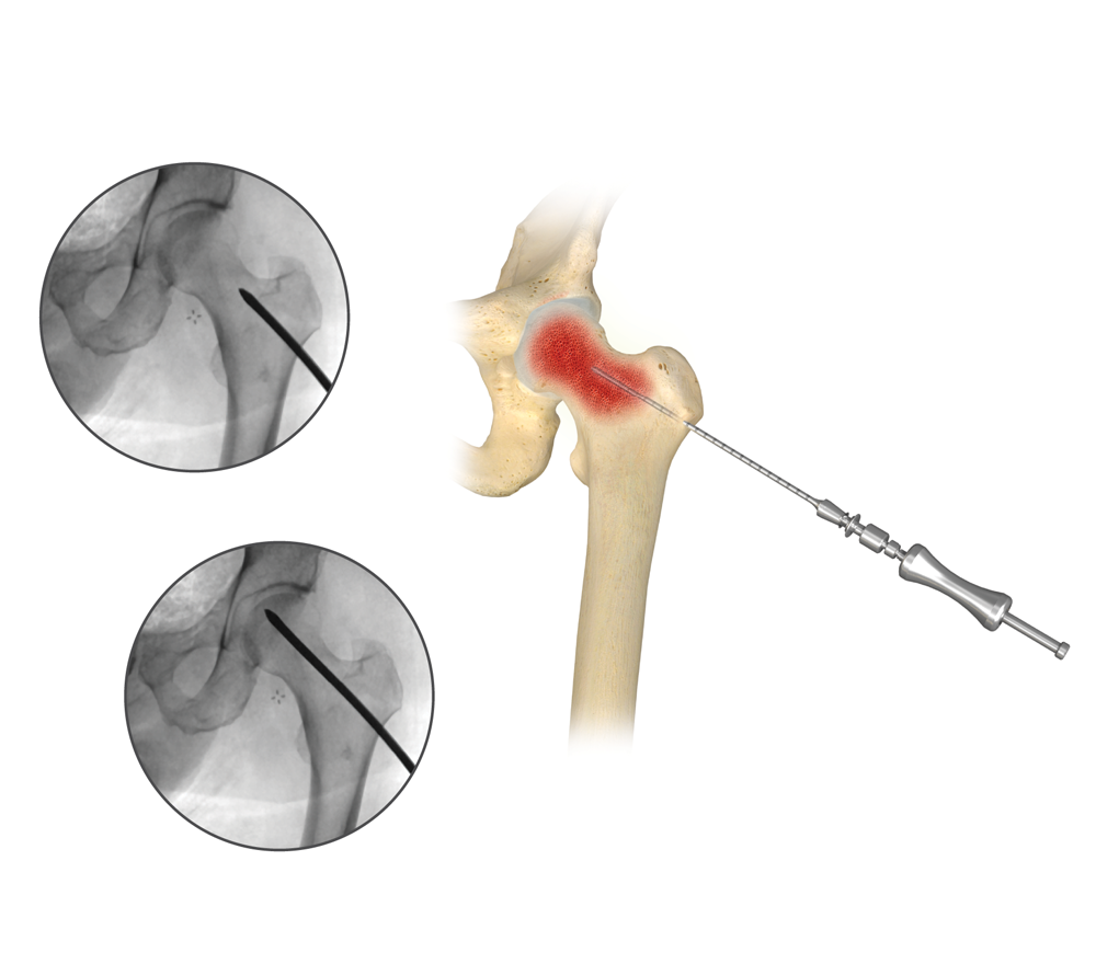 PerFuse™ Percutaneous Decompression System