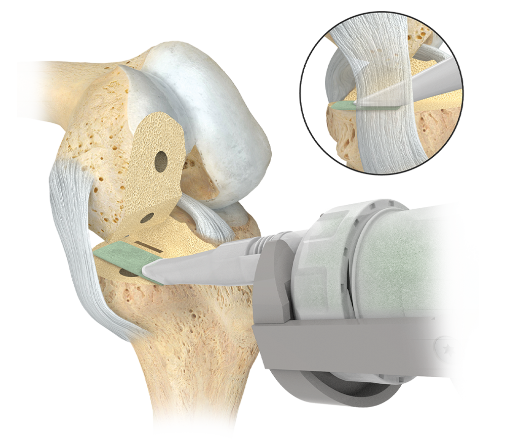 Modern Cementing Technique