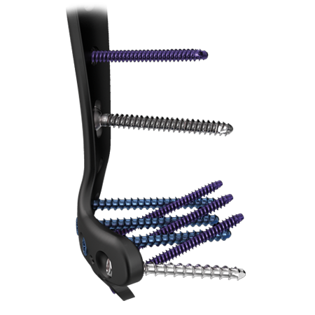 A.L.P.S.® Distal Tibia Plating Systems