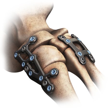 A.L.P.S® Total Foot System