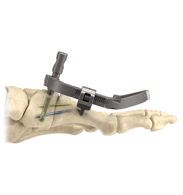 InCore® Lapidus System