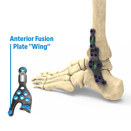 Stratum® Ankle Fusion Plating System