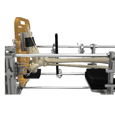 Trabecular Metal™ Total Ankle | Zimmer Biomet