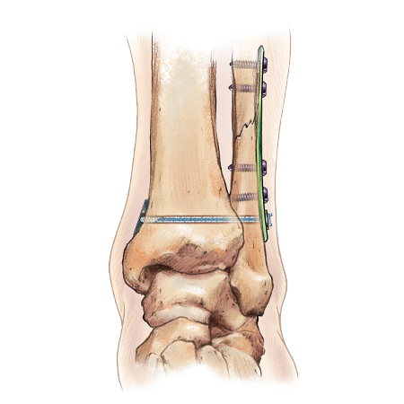 ZipTight™ Ankle Fixation System | Zimmer Biomet