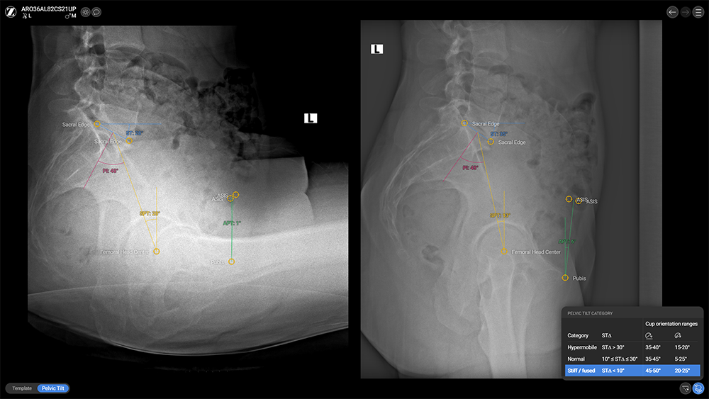 ONE Planner® Hip: Pre-op Planning | Zimmer Biomet