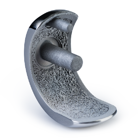 Oxford Cementless Partial Knee Replacement | Zimmer Biomet