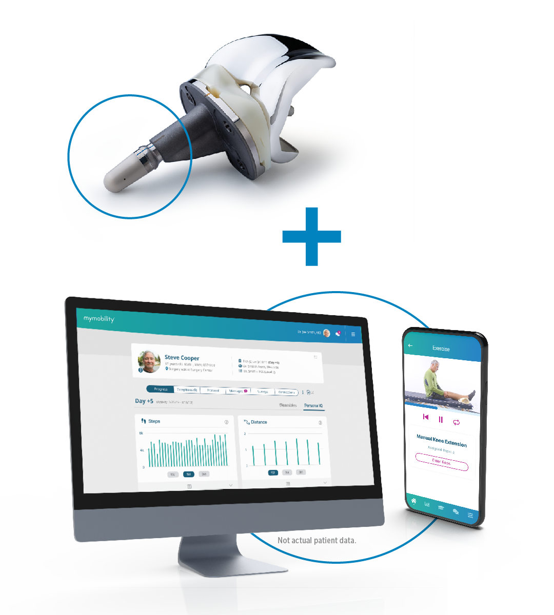 Persona IQ® | Smart Knee Implant Technology for Surgeons