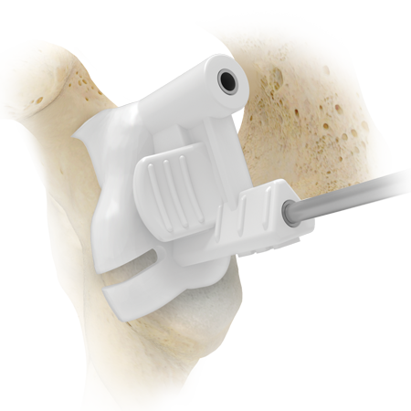 Signature™ ONE Surgical Planning | Zimmer Biomet