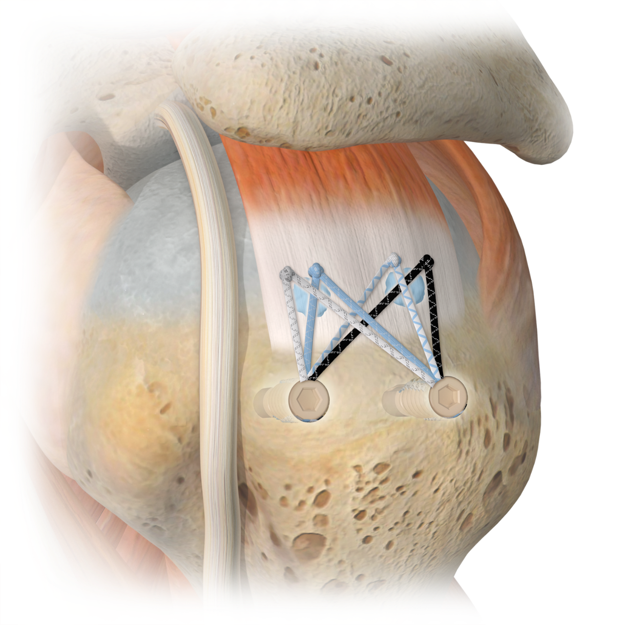 JuggerKnot® All-Suture Anchors for Rotator Cuff Repair