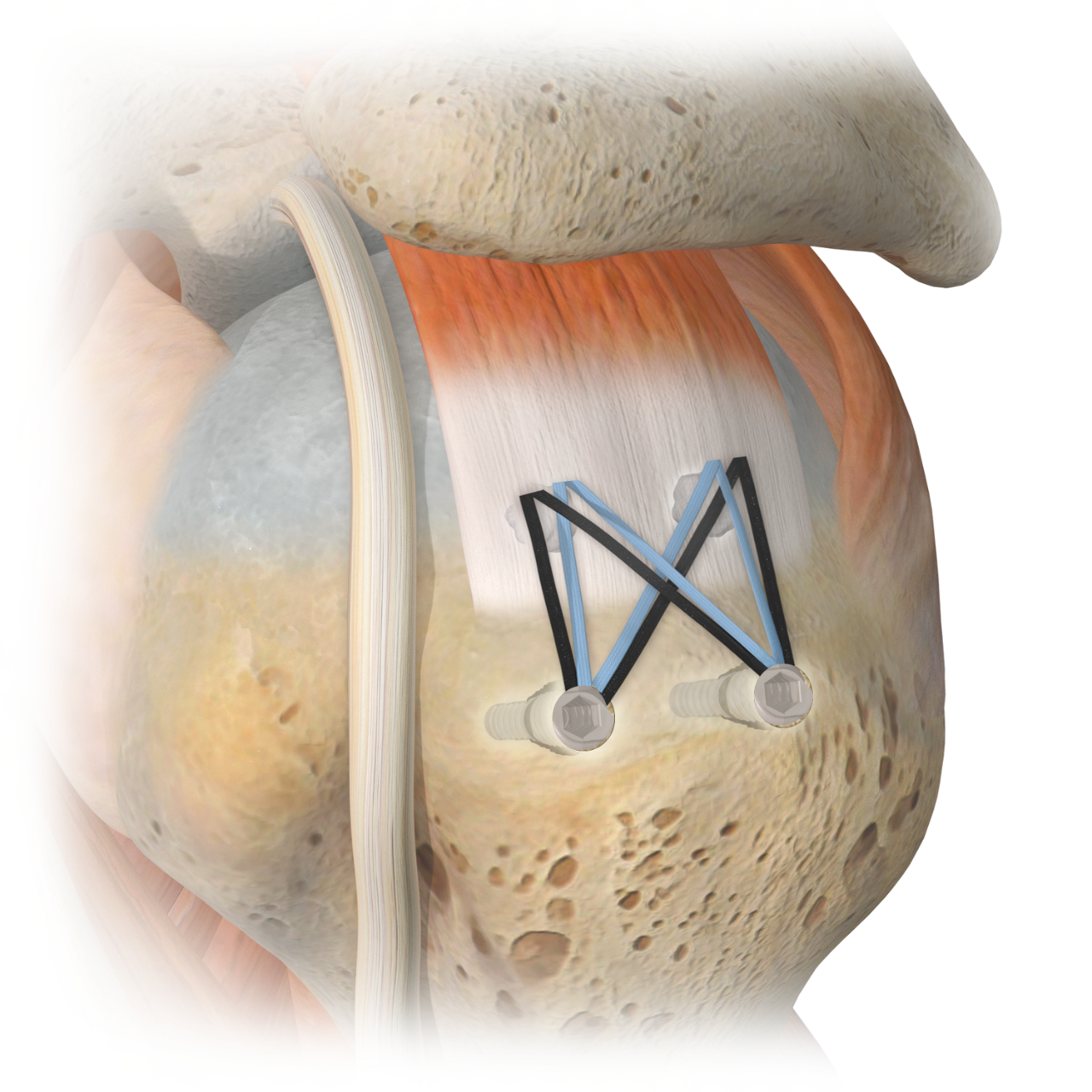JuggerKnot® All-Suture Anchors for Rotator Cuff Repair