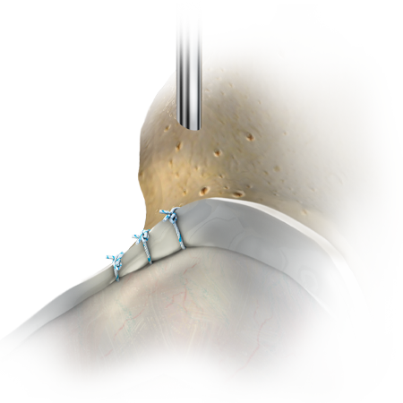 JuggerKnot® Soft Anchor System | Zimmer Biomet