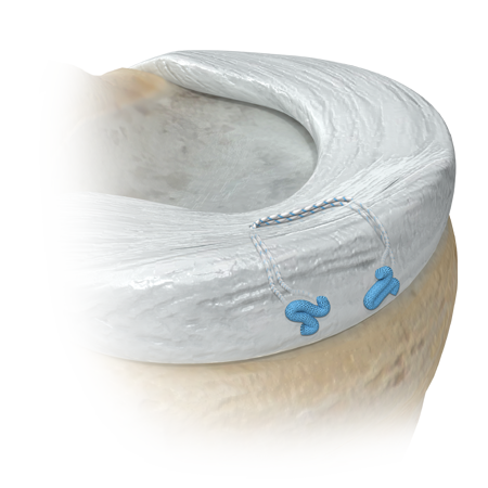 JuggerStitch™ Meniscal Repair Device