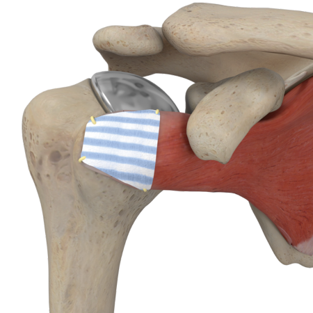 Tapestry® Biointegrative Implant