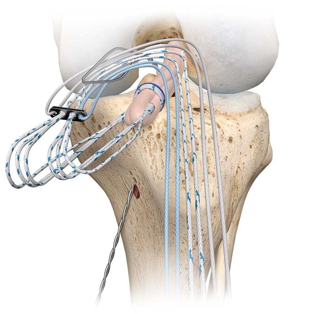 ToggleLoc® Flip Inline with ZipLoop® Technology | ACL Suspensory Button ...