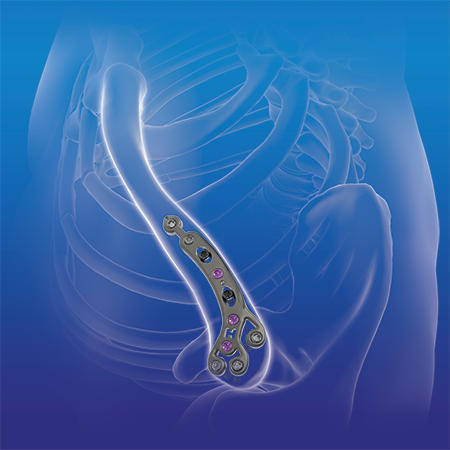 A.L.P.S® Clavicle Plating System