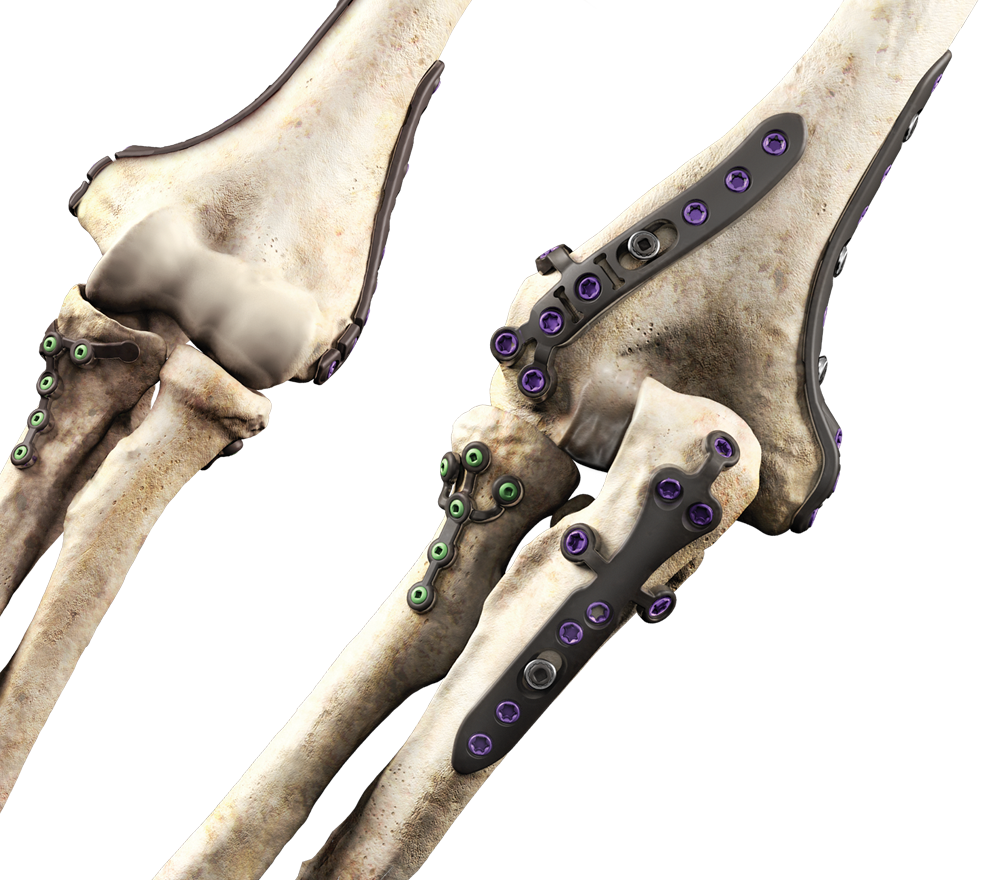 A.L.P.S® Elbow Fracture System