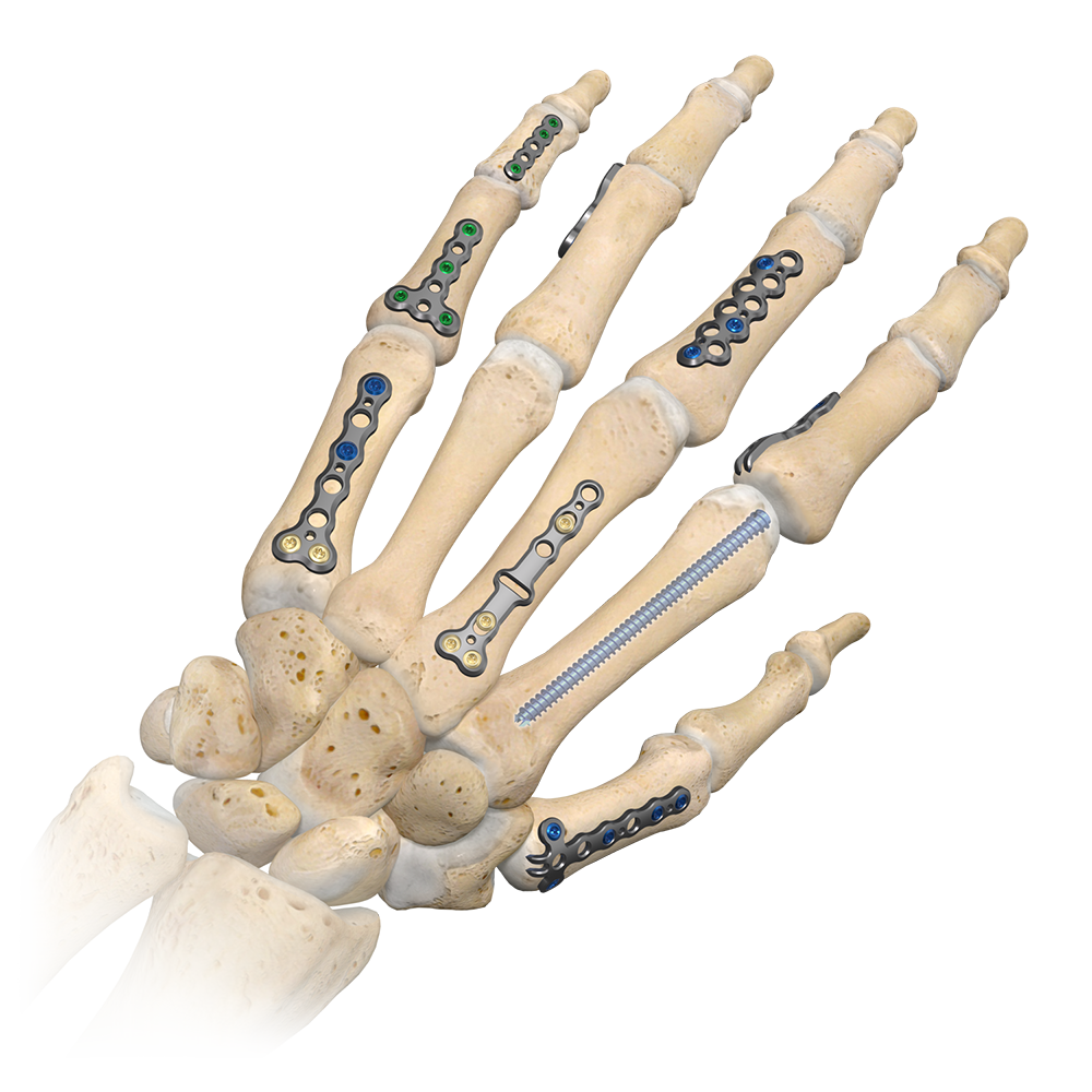 A.L.P.S. mvX™ Hand System | Zimmer Biomet