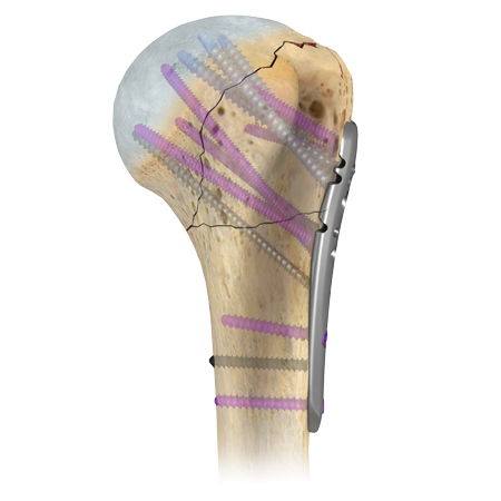 A.L.P.S® Proximal Humerus Plating System