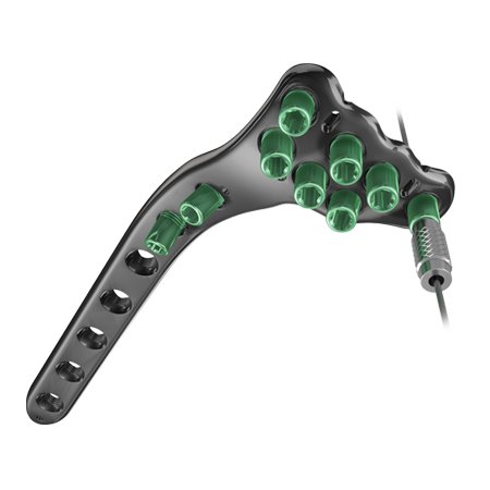 A.L.P.S® Proximal Tibia Plating System