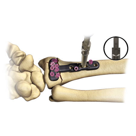 DVR® Plating System